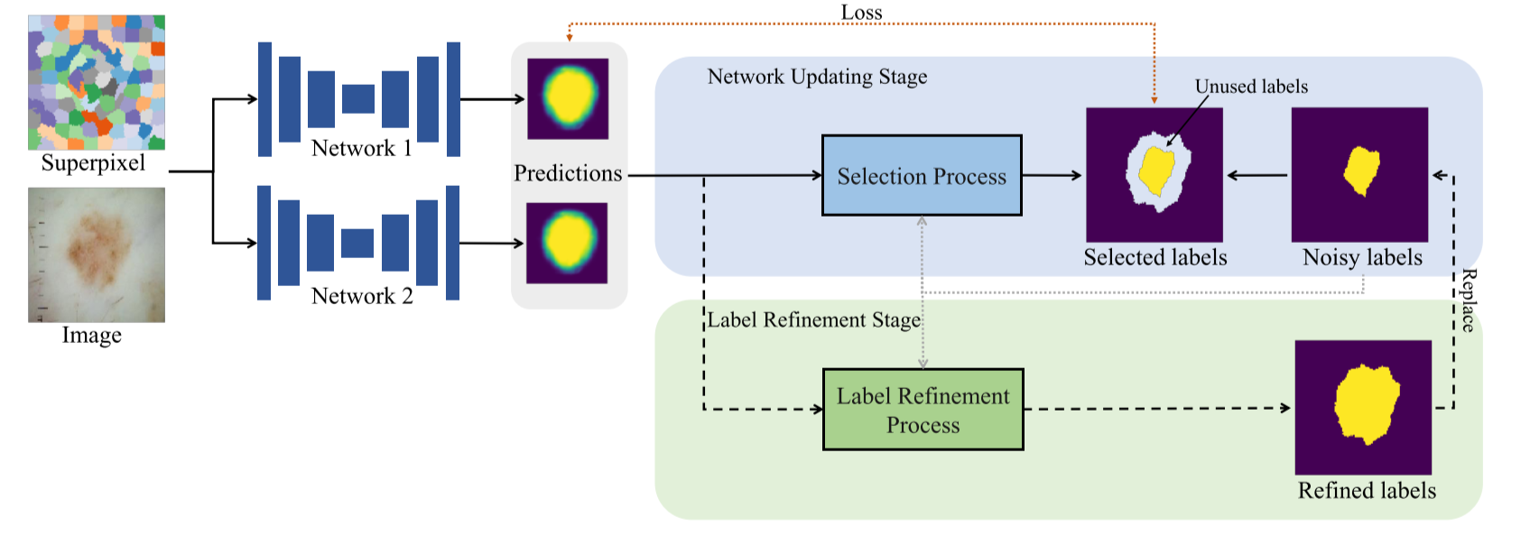 Superpixel-guided Iterative Learning from Noisy Labels for Medical Image Segmentation | PLUS